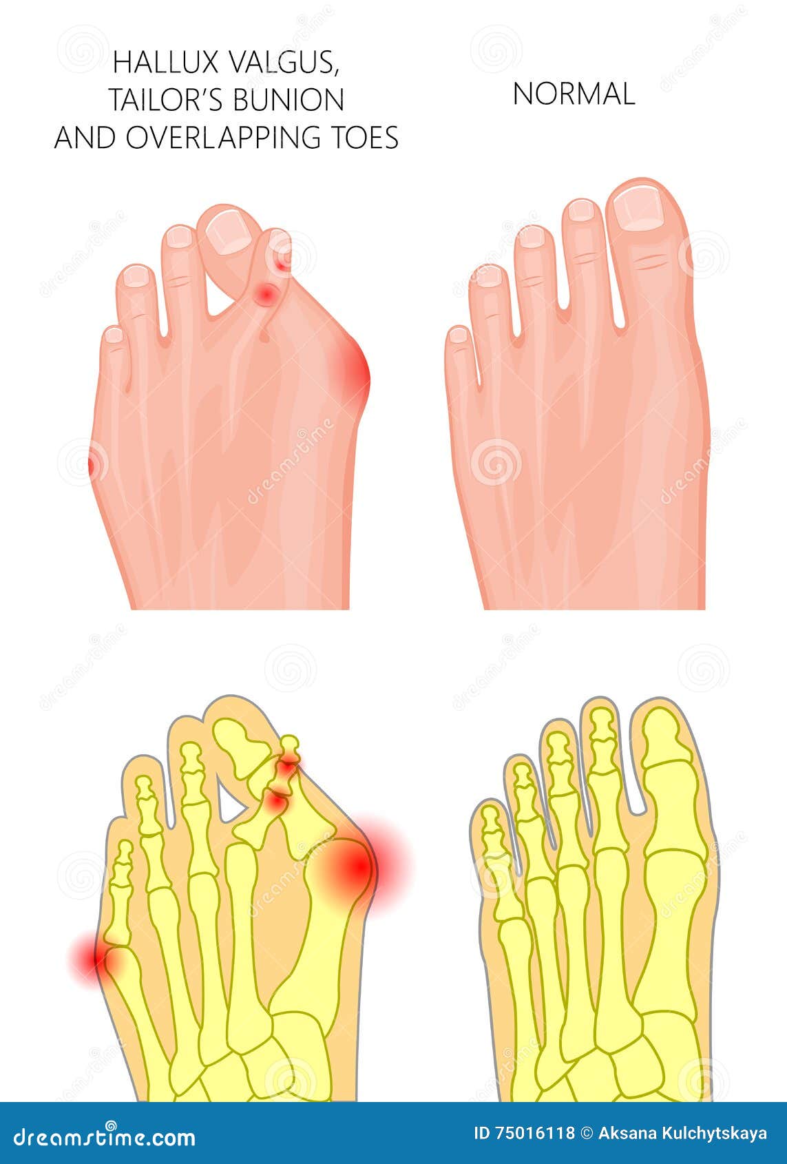 Overlapping toes stock vector. Illustration of deviation - 75016118
