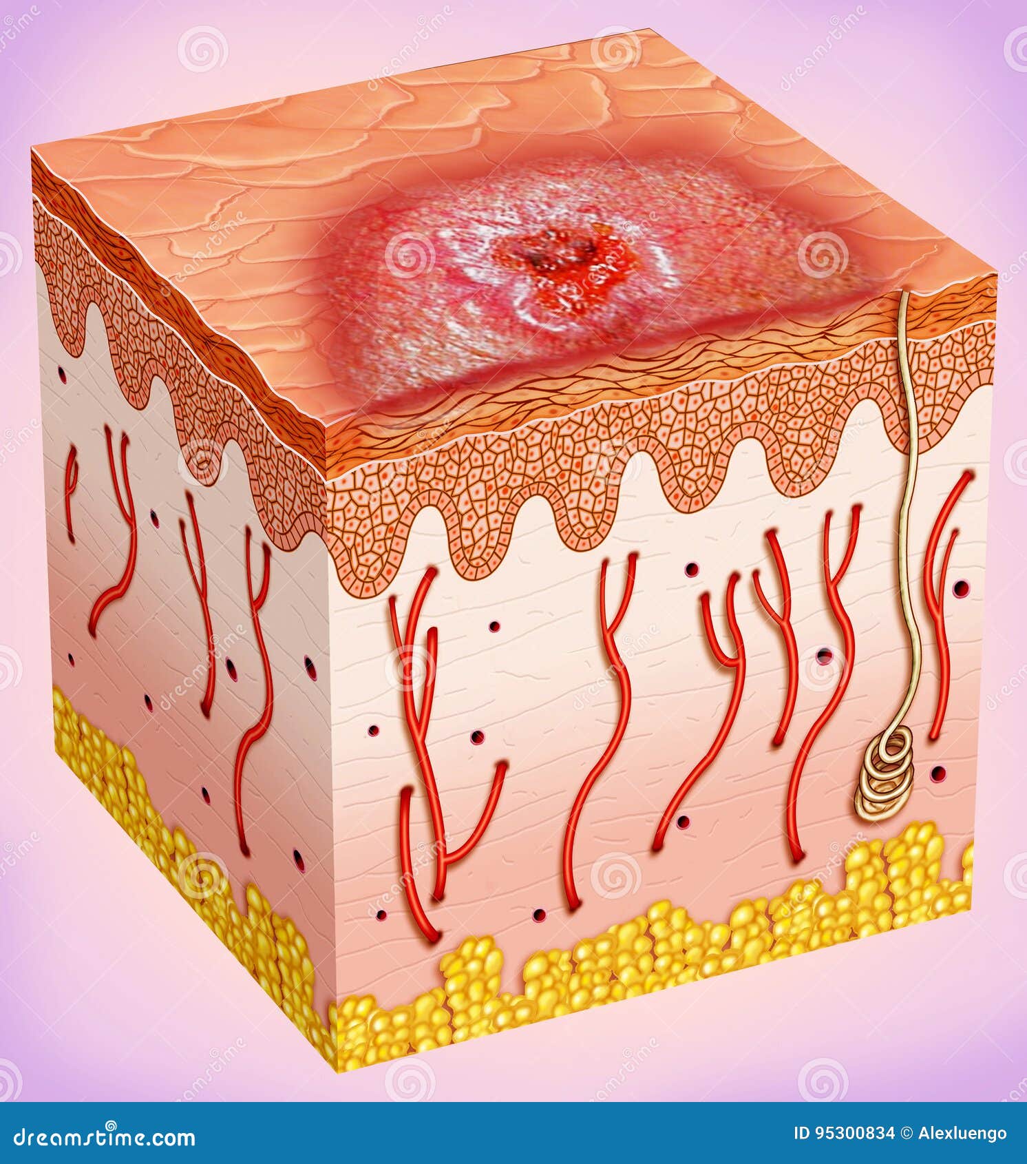 Overzicht van huidkanker stock illustratie. Illustration of carcinoom ...