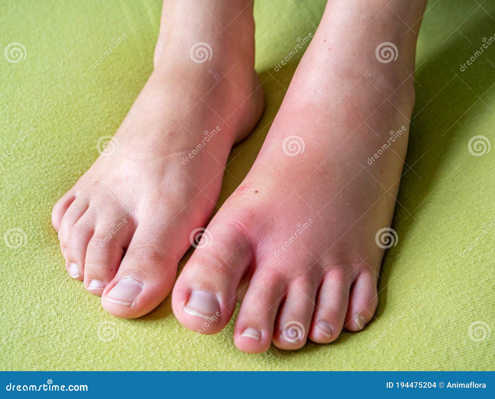 Pé Inchado Após Picada De Inseto Foto de Stock - Imagem de mosquito ...