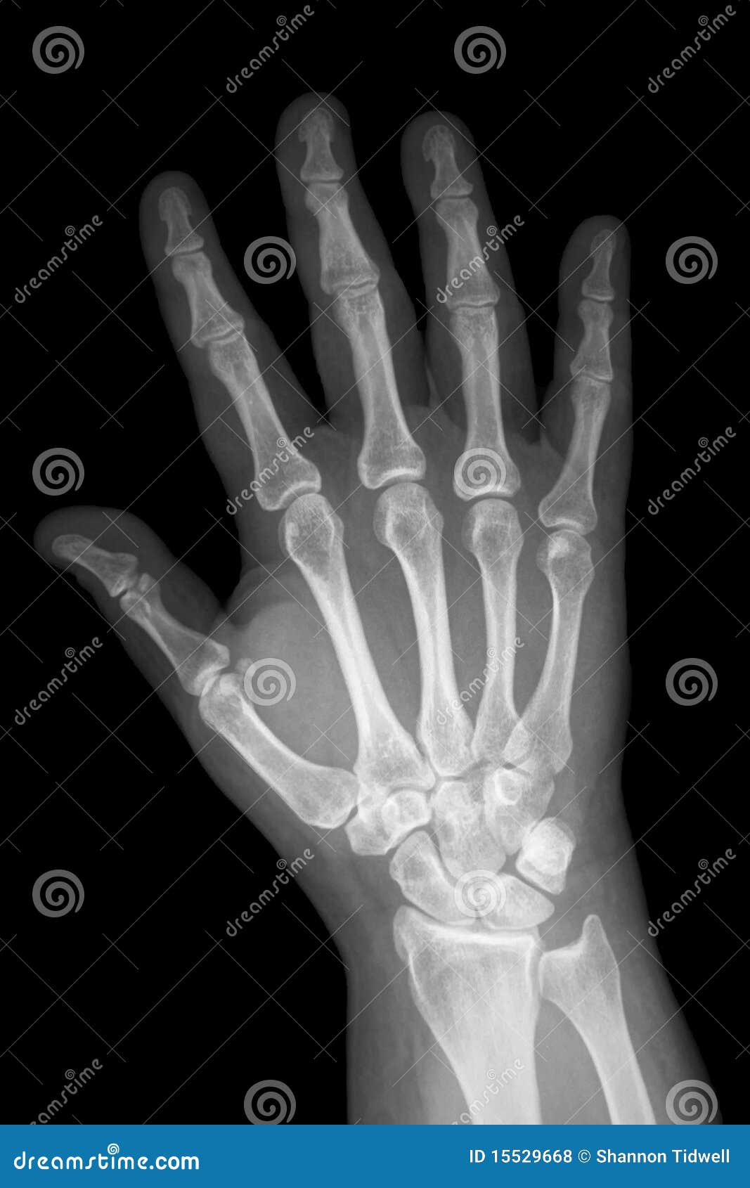 PA hand x-ray stock photo. Image of hand, grey, vertical - 15529668