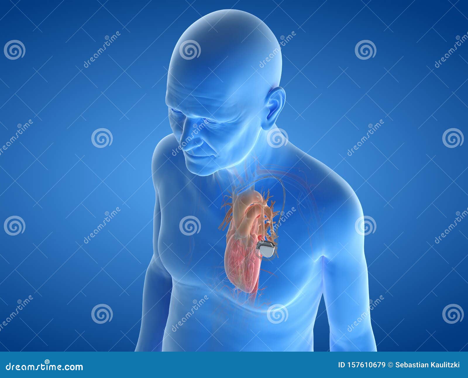 A Pace Maker Stock Illustration | CartoonDealer.com #157610584