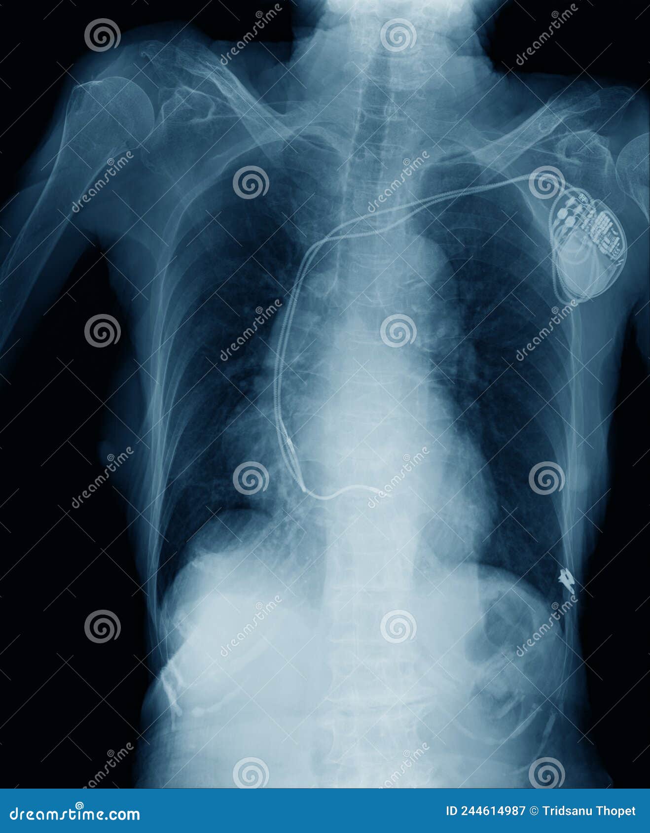 Pacemaker Cell in Patient for Keep Working Electrical Wave in Human ...