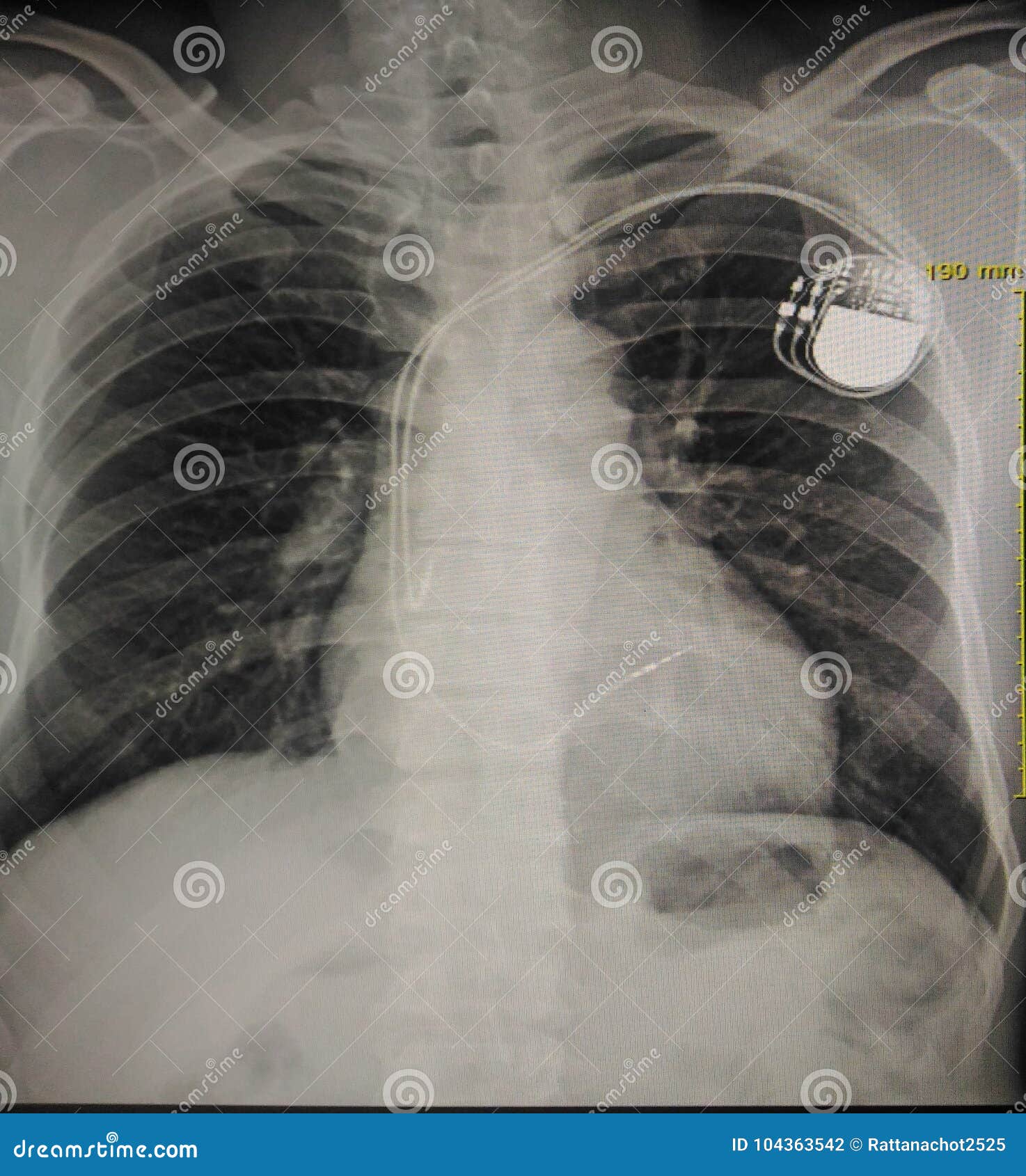 Pacemaker stock photo. Image of white, human, injury - 104363542