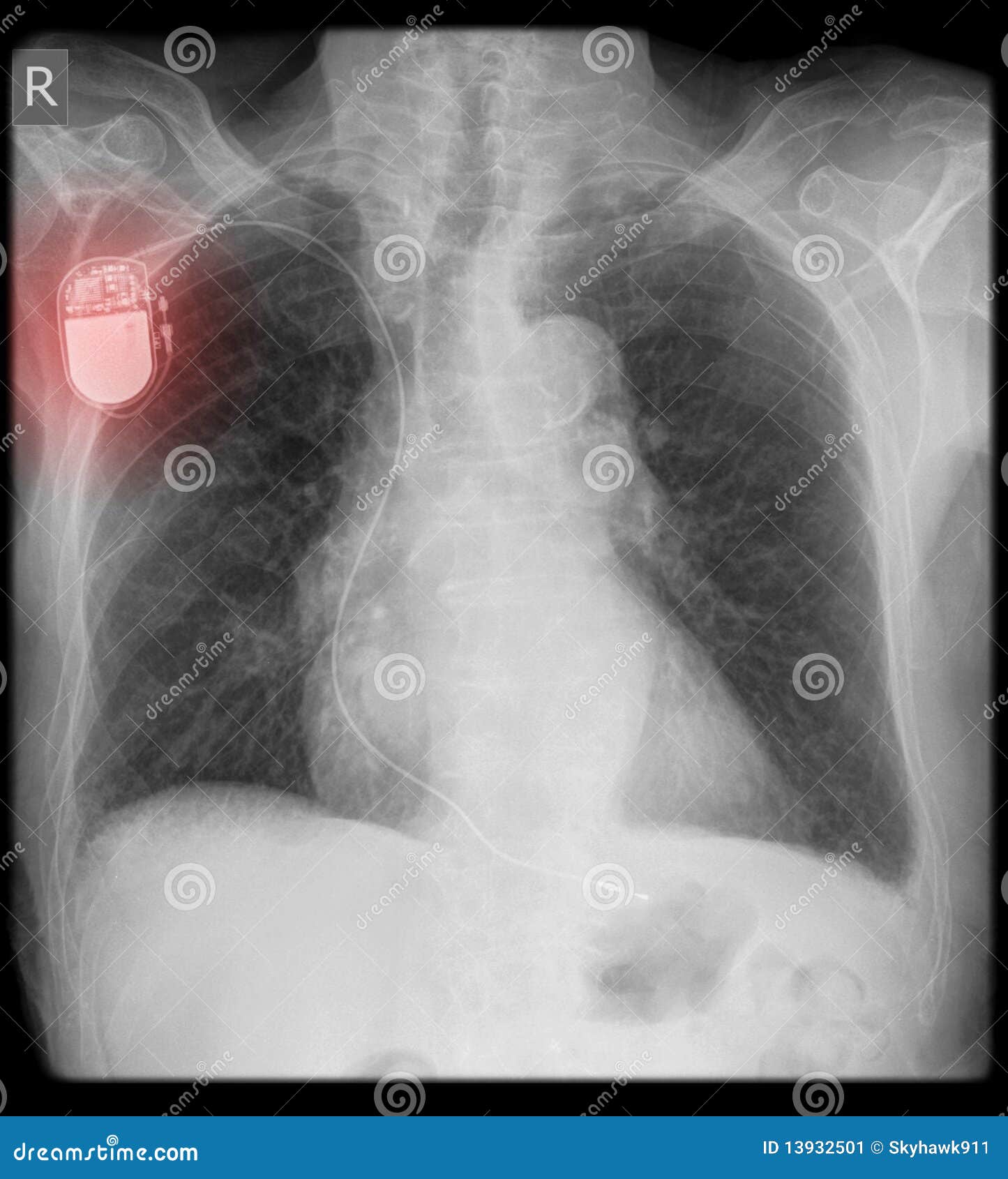 Pacemaker on X-ray with Wire Stock Image - Image of human, coronary ...