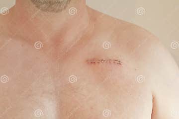 Pacemaker scar stock image. Image of implant, murmur - 25735675
