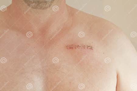 Pacemaker scar stock image. Image of implant, murmur - 25735675
