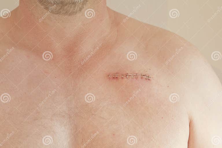 Pacemaker scar stock image. Image of implant, murmur - 25735675