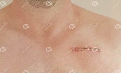 Pacemaker scar stock photo. Image of conditions, implant - 31037390