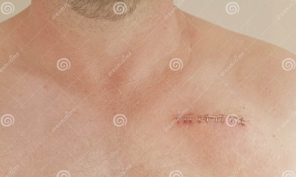 Pacemaker scar stock photo. Image of conditions, implant - 31037390