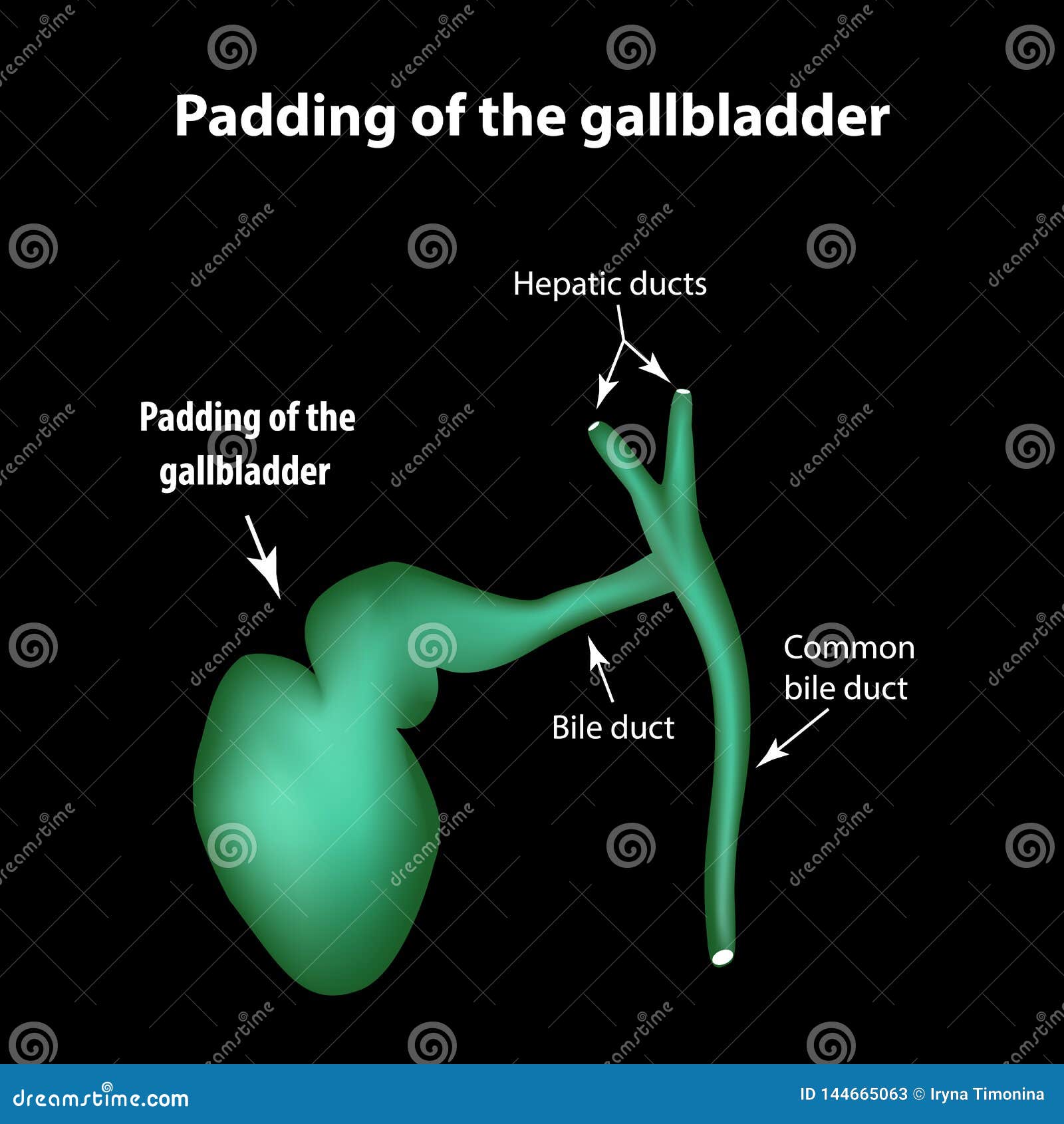 Padding Of The Gallbladder. Pathology Of The Gallbladder. Cholecystitis ...