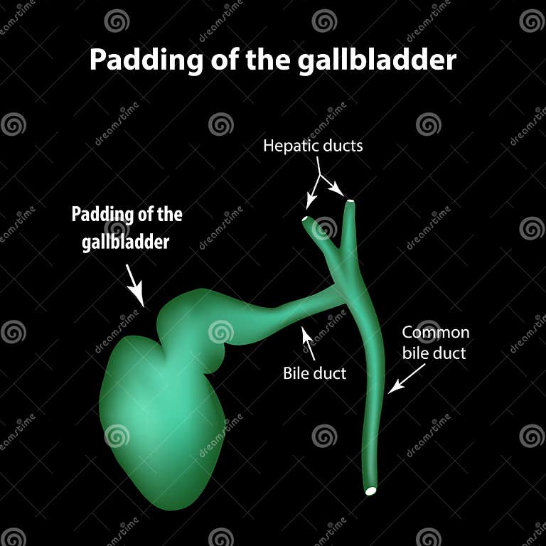 Padding of the Gallbladder. Pathology of the Gallbladder. Cholecystitis ...