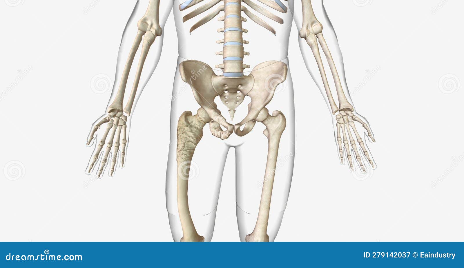 The Paget is Disease of Bone Stock Illustration - Illustration of ...