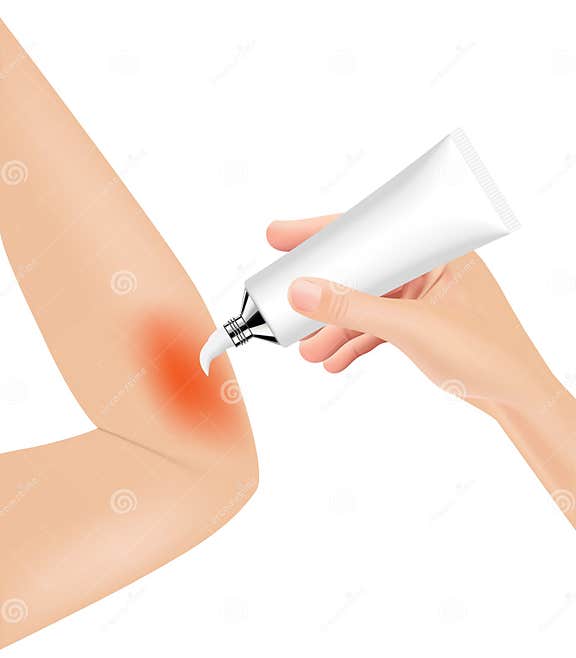 Skin Burn Injury Treatment. First Aid for Burn Wound Vector ...