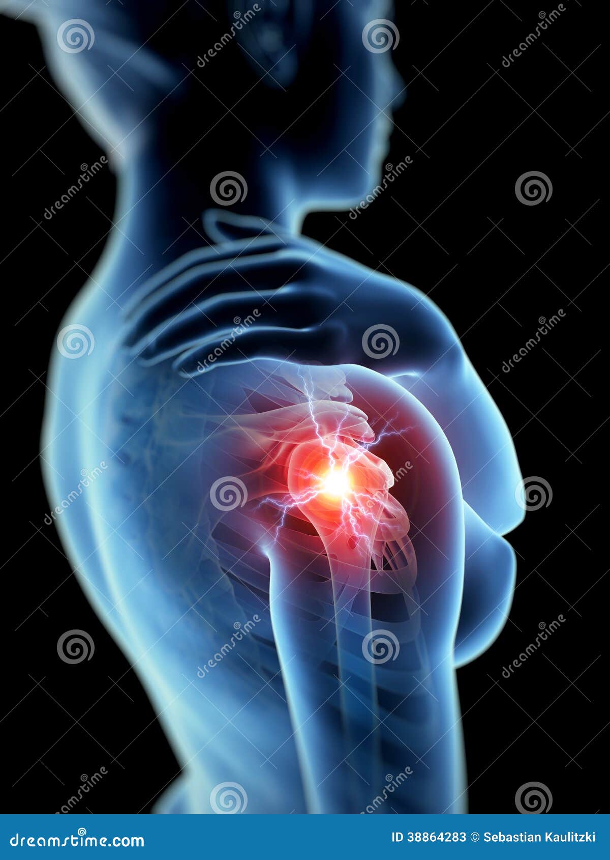 Shoulder Joint. Shoulder Impingement. Labeled Illustration Stock ...
