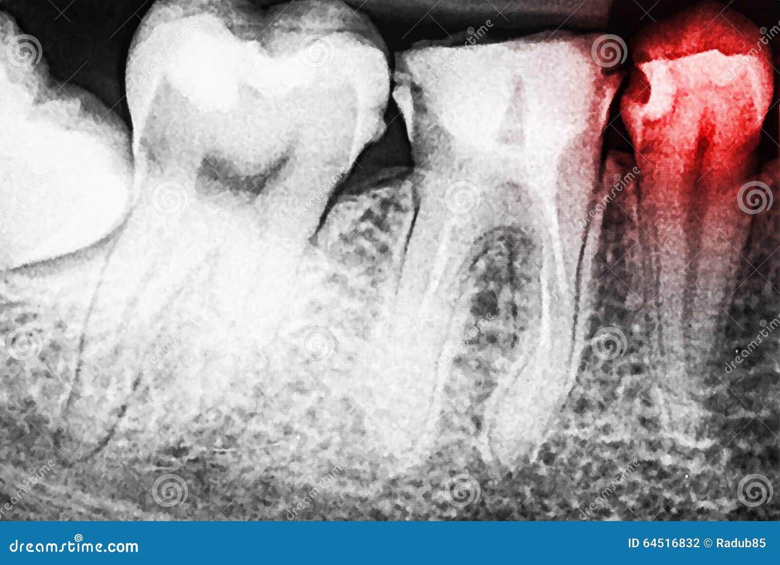 Pain of Tooth Decay on X-Ray Stock Photo - Image of canal, dentistry ...