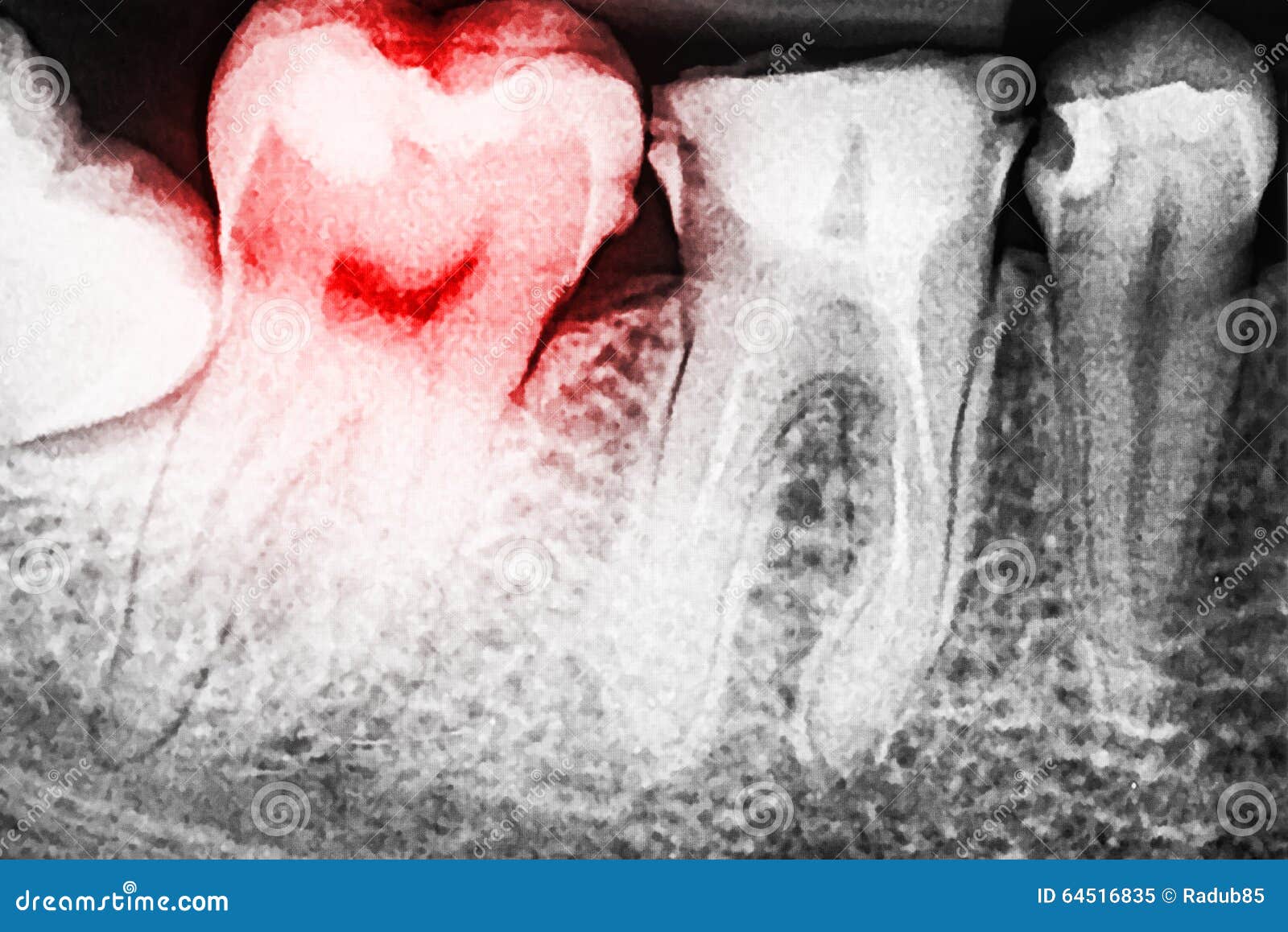 Pain of Tooth Decay on X-Ray Stock Image - Image of human, radiography ...
