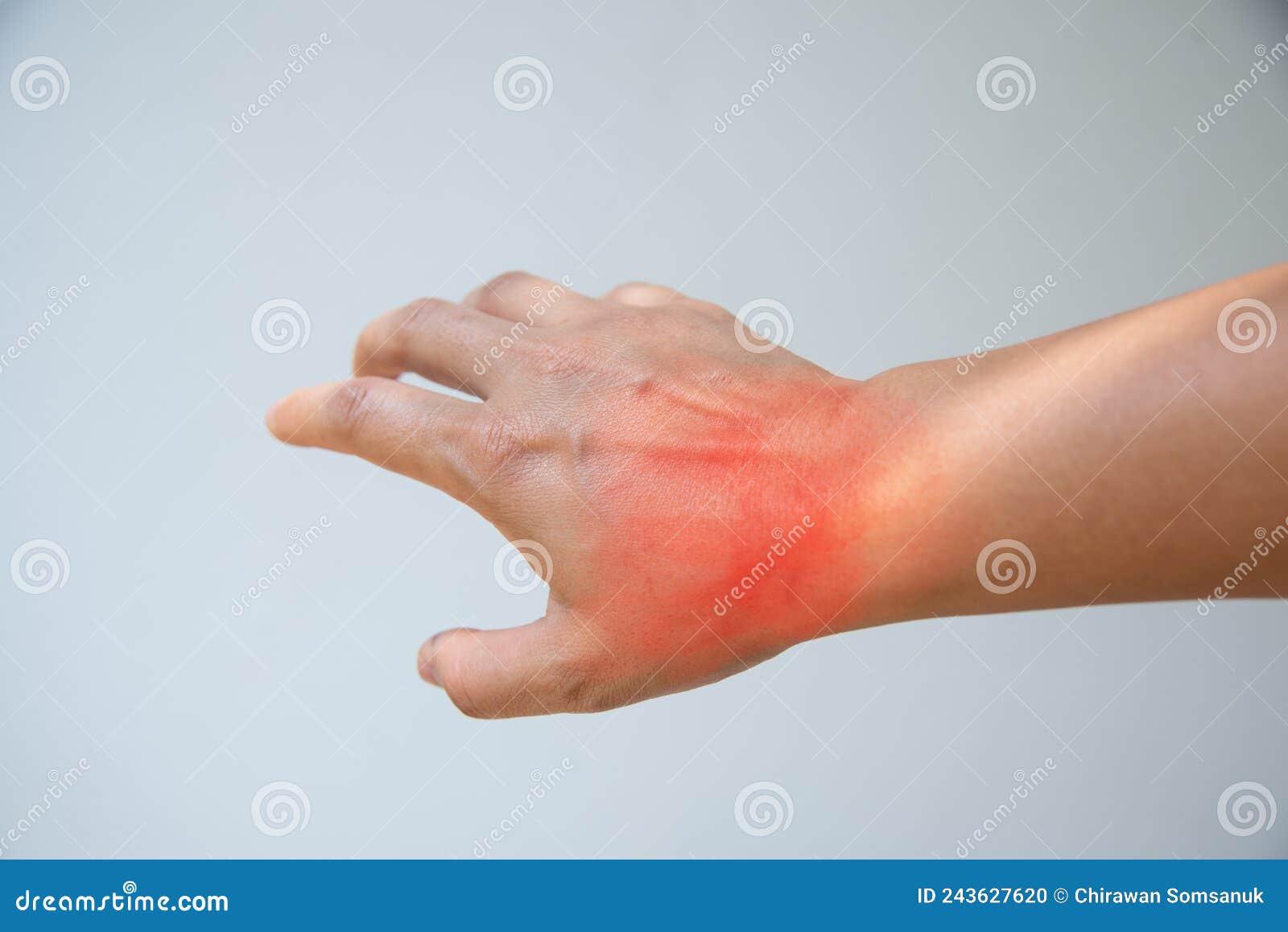 Painful Hand of Rhumatoid Arthritis Stock Photo - Image of pain, ache ...