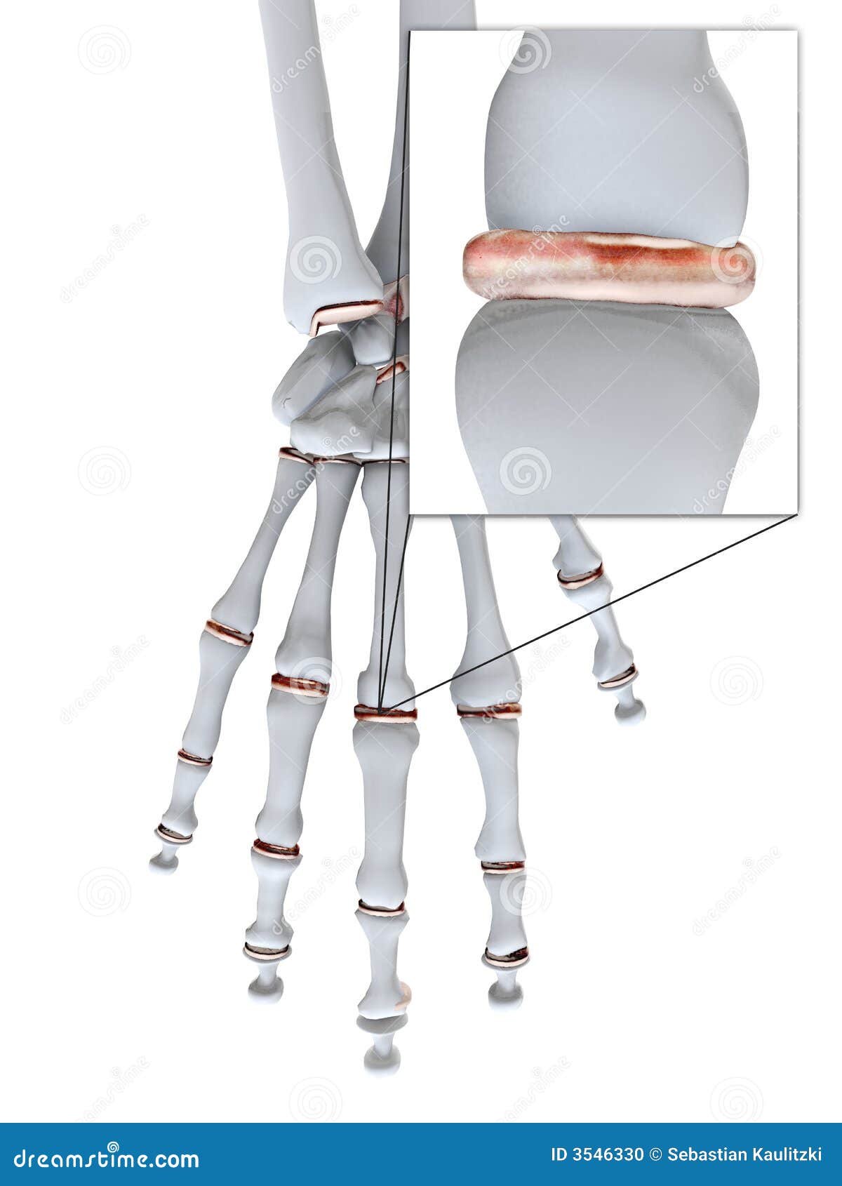 Painful Handjoints/arthritis Stock Photo | CartoonDealer.com #3546330