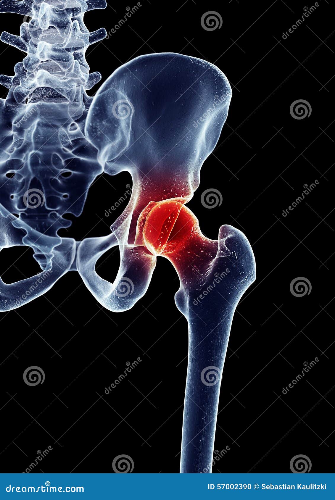 Illustration Of Painful Hip Sacral Inflammation, Hip Pain Bursitis ...