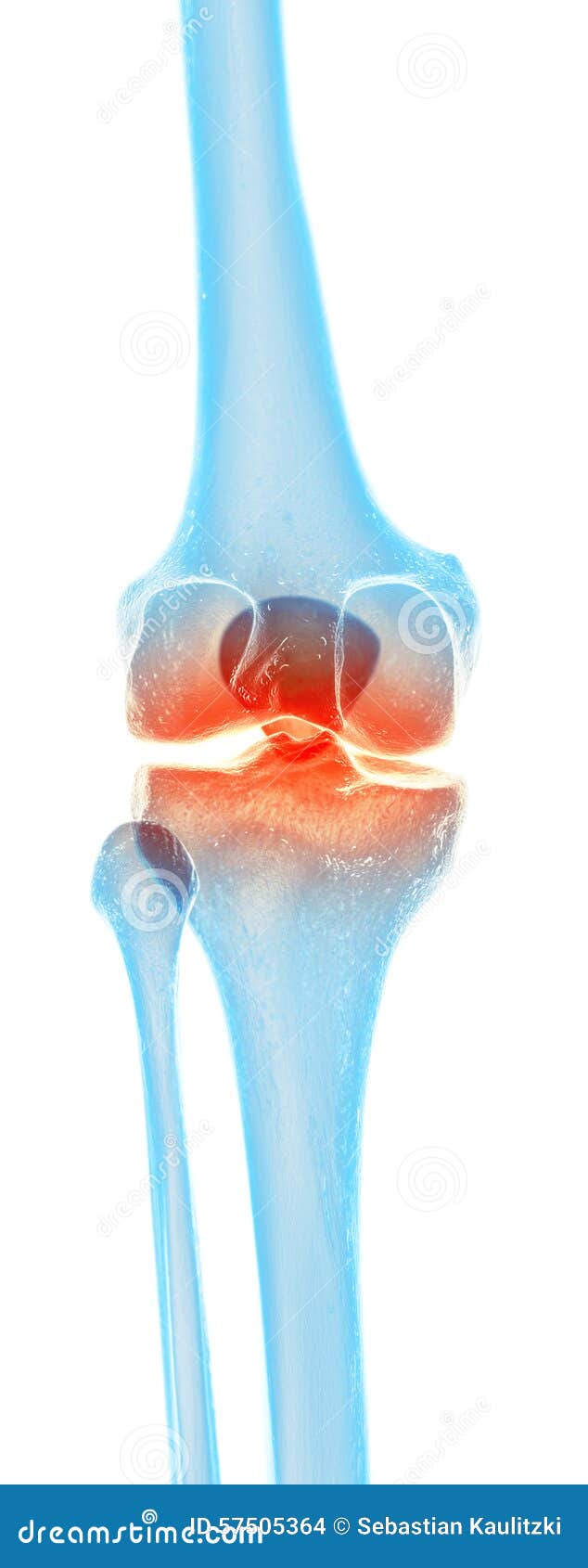 Painful knee stock illustration. Illustration of rheumatism - 57505364