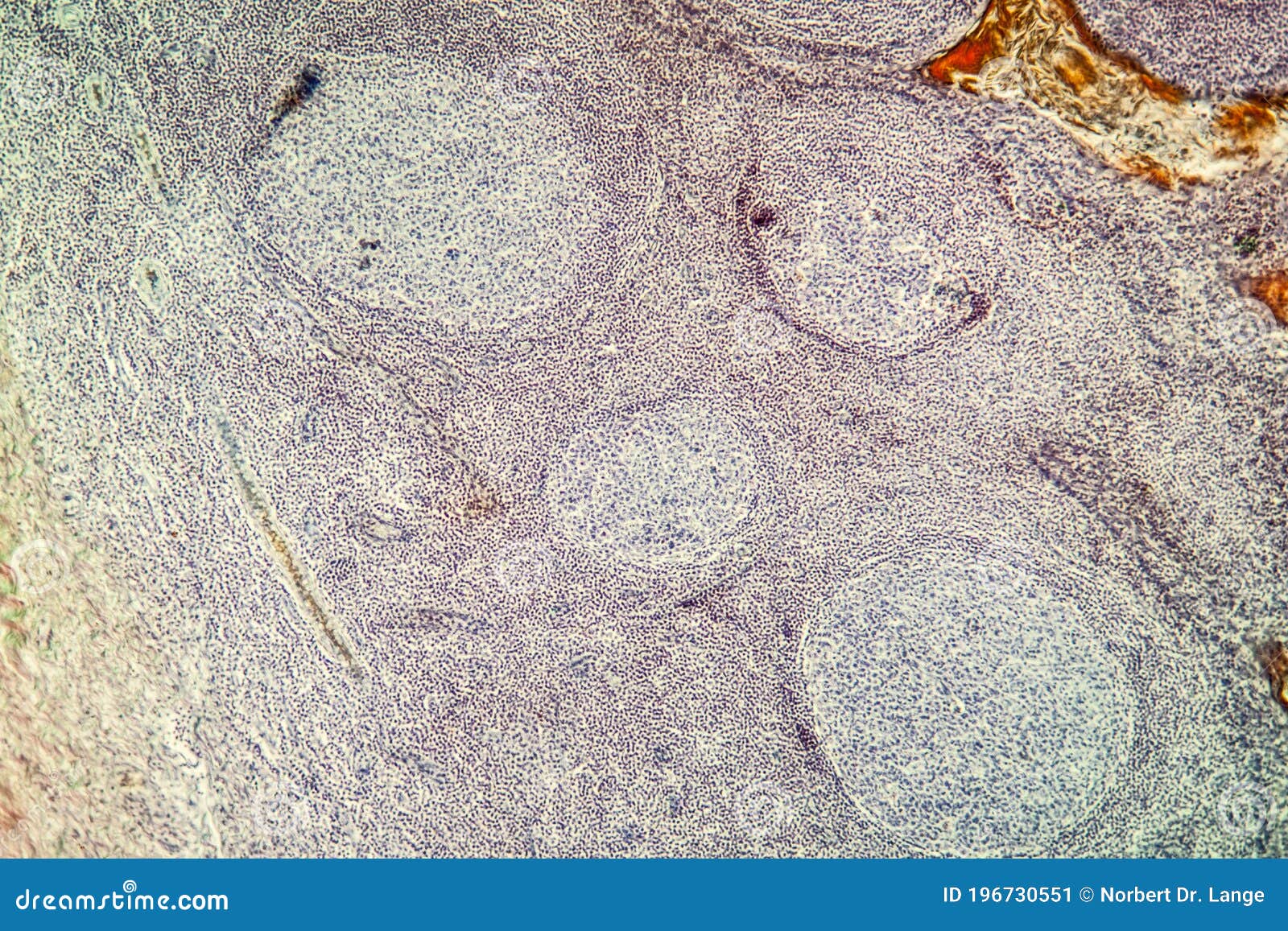 Palatal tonsils transverse stock image. Image of epithelial - 196730551