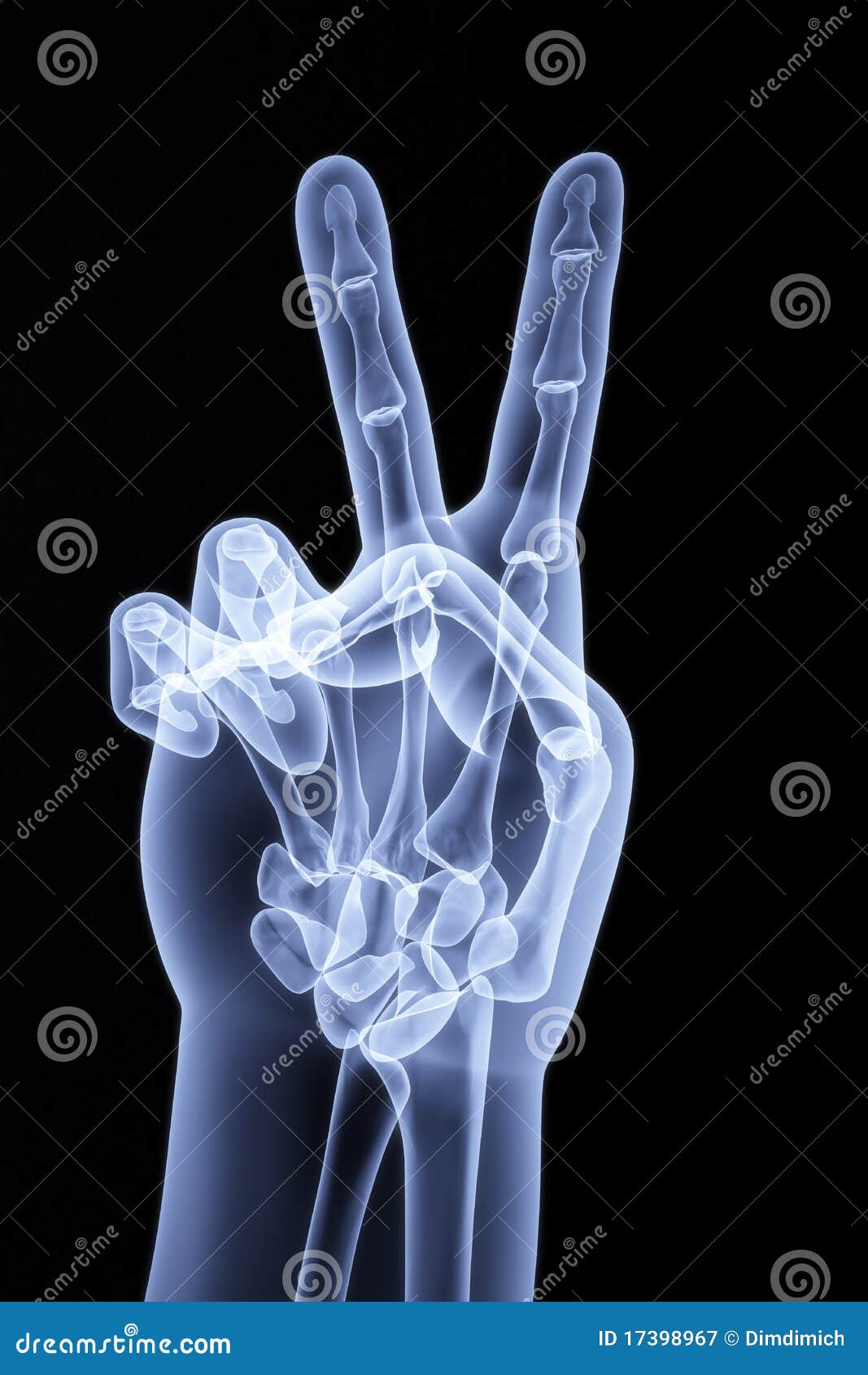 Radiogram Of Hand. X-ray Or Roentgenogram. Vector Illustration Of ...