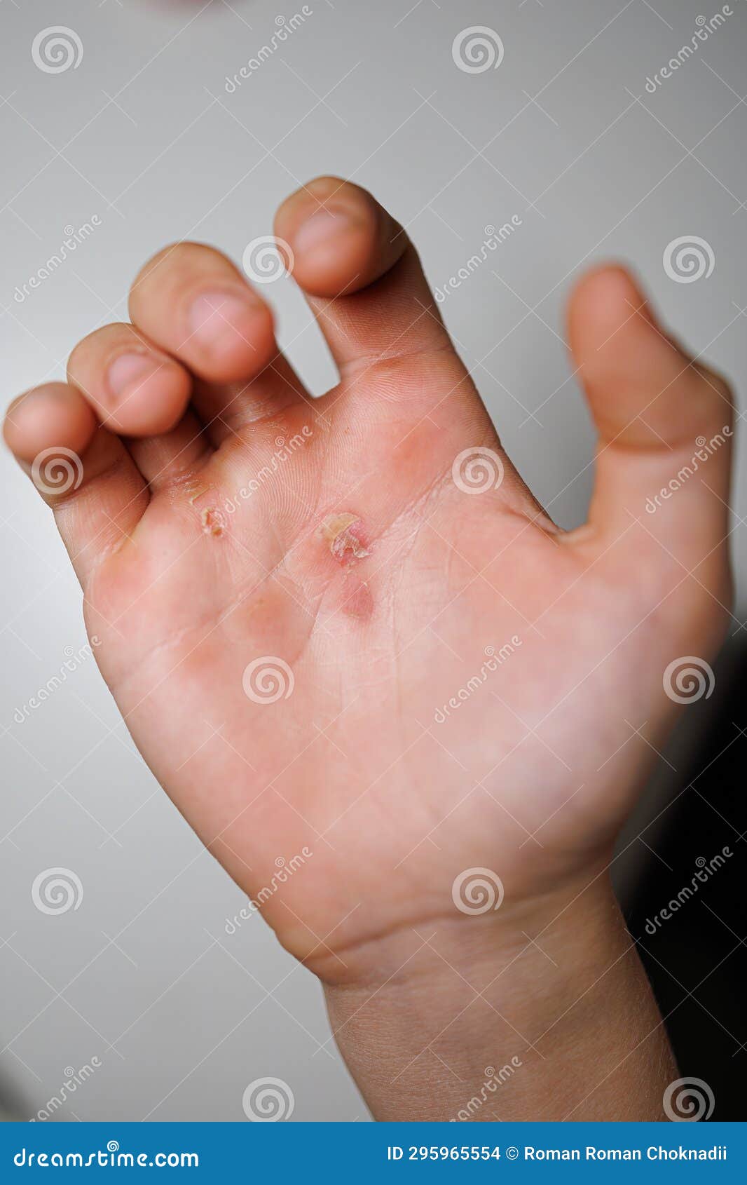 The Palm of an Athlete S Hand after Training a Lacerated Callus on the ...