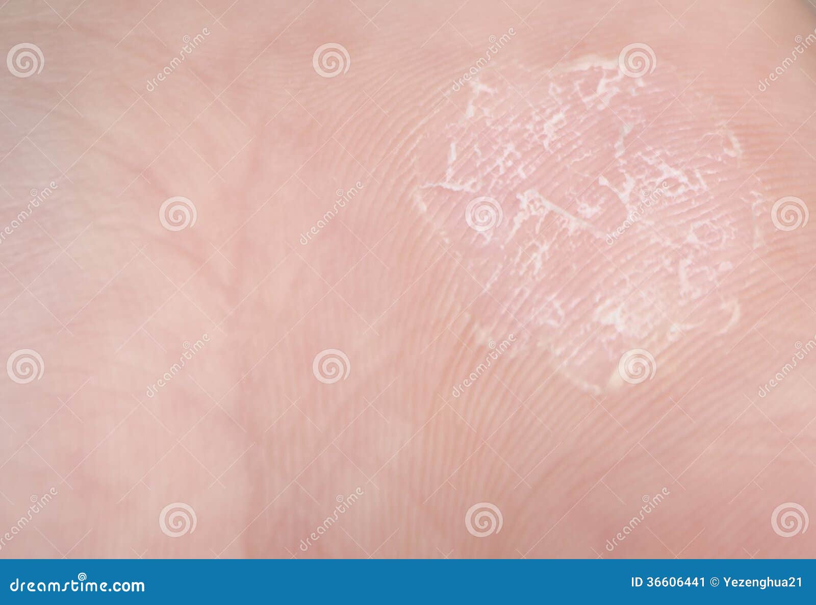 The palm skin fall off stock image. Image of rash, people - 36606441