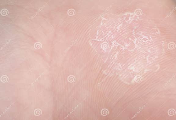 The palm skin fall off stock image. Image of rash, people - 36606441