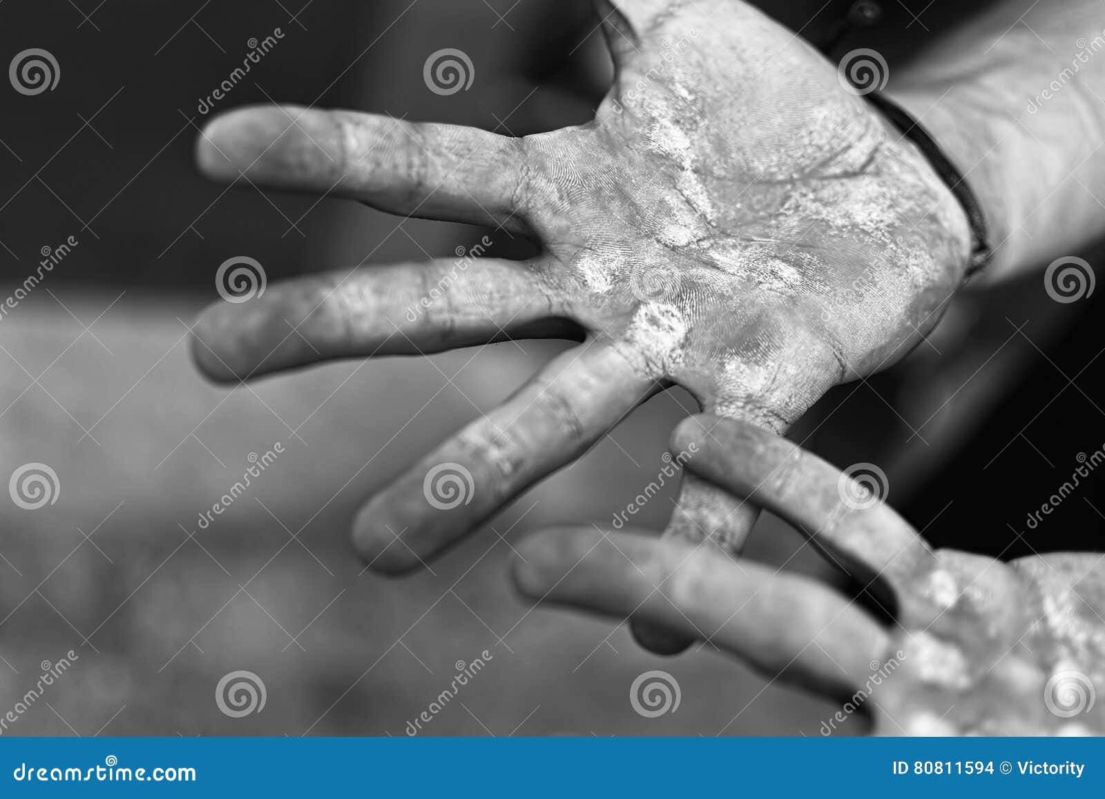 Palms with Calluses. Blisters on the Injured Hands from Manual Work ...