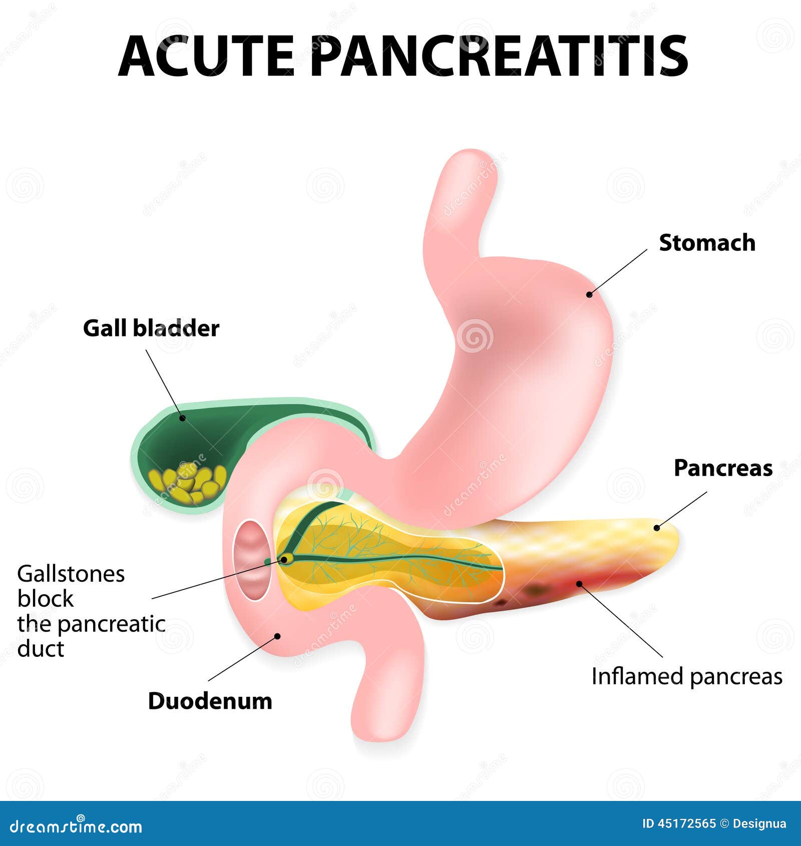 Pancréatite Aiguë Illustration de Vecteur - Image: 45172565
