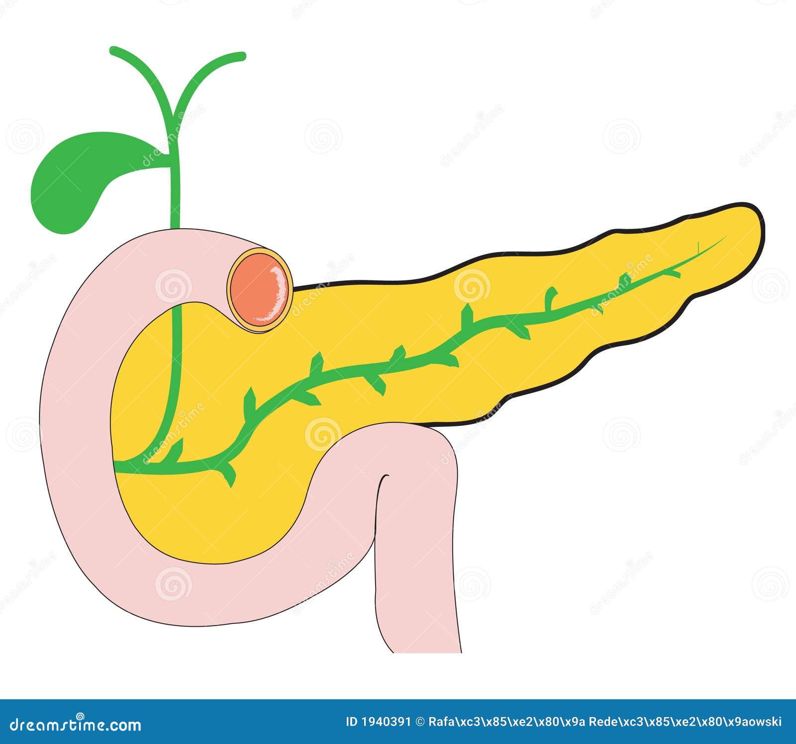 Pancreas Mucous Cystadenoma, Adenocarcinoma. Vector Illustration On A ...