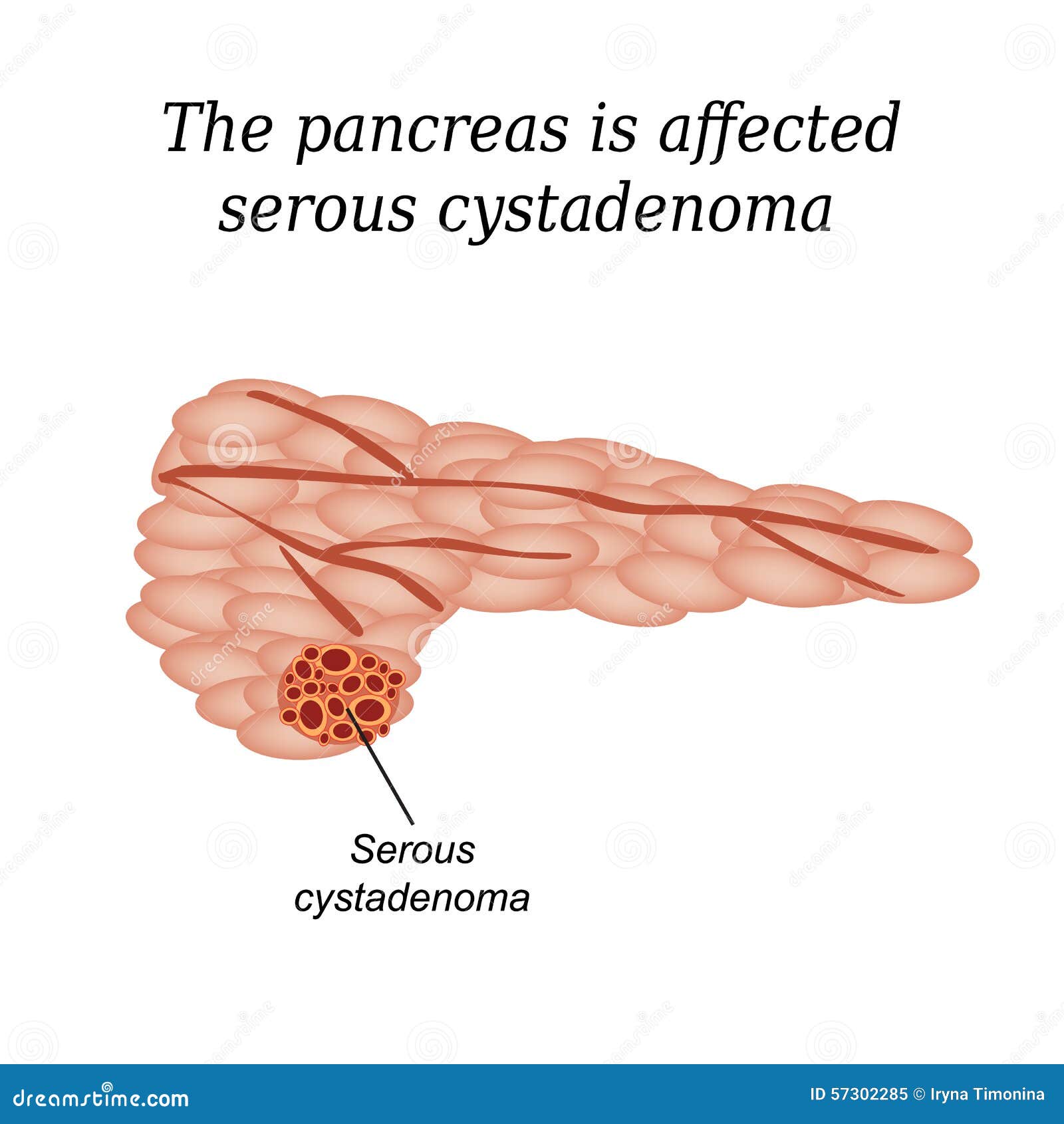 The Pancreas Is Affected Serous Cystadenoma. Vector Illustration On A ...