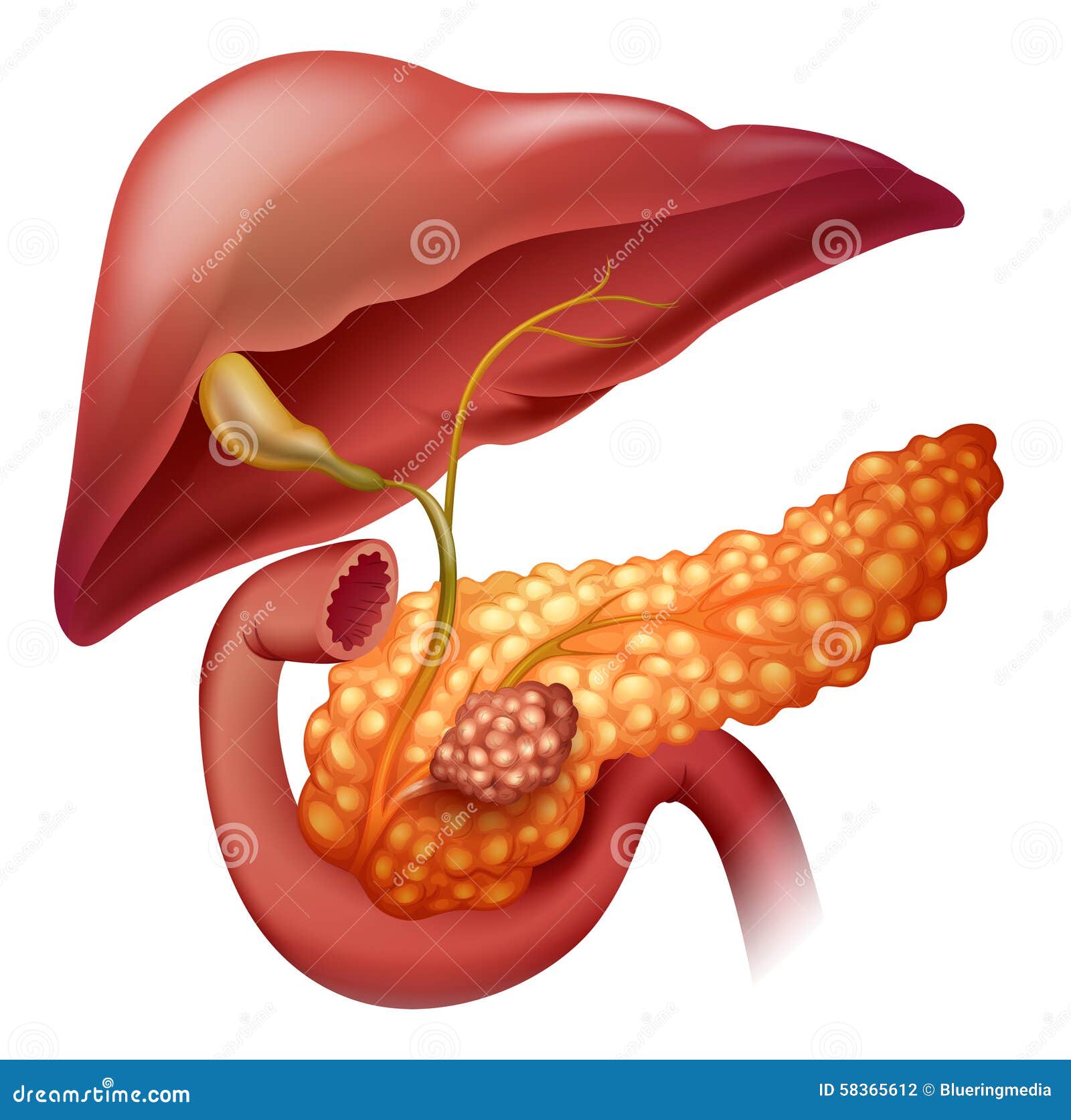 Pancreas Cancer Diagram on White Stock Vector - Illustration of tissue ...
