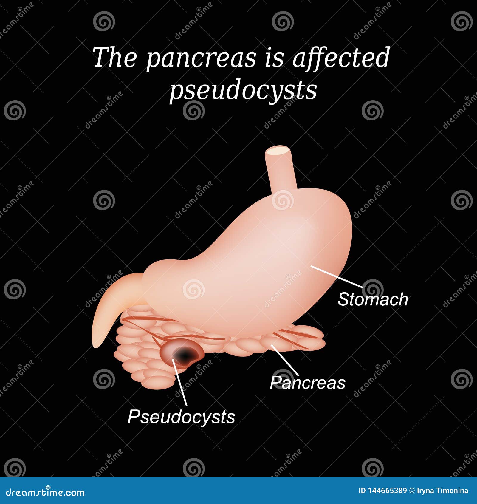 Pancreas Pseudocyst Affected. Vector Illustration On A Black Background ...