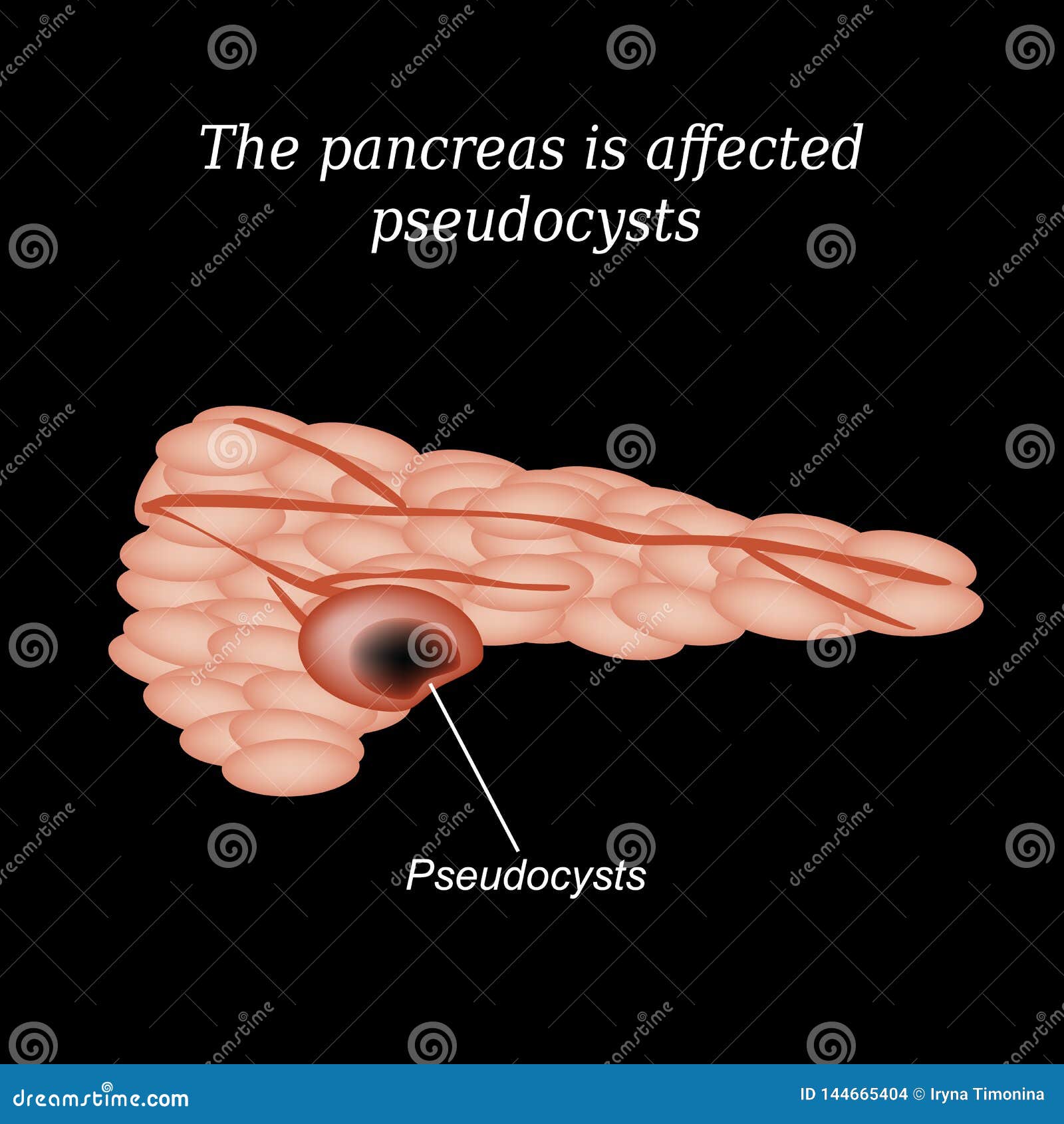 Pancreas Pseudocyst Affected. Vector Illustration on a Black Background ...