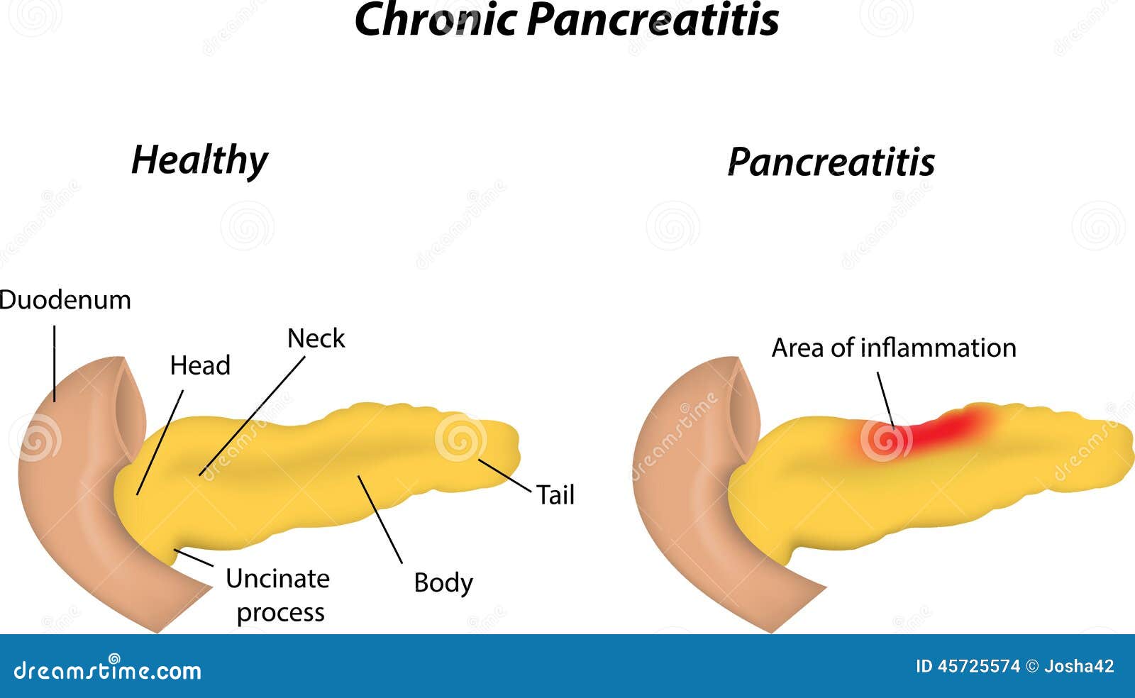 Pancreatite cronica illustrazione vettoriale. Illustrazione di salute ...