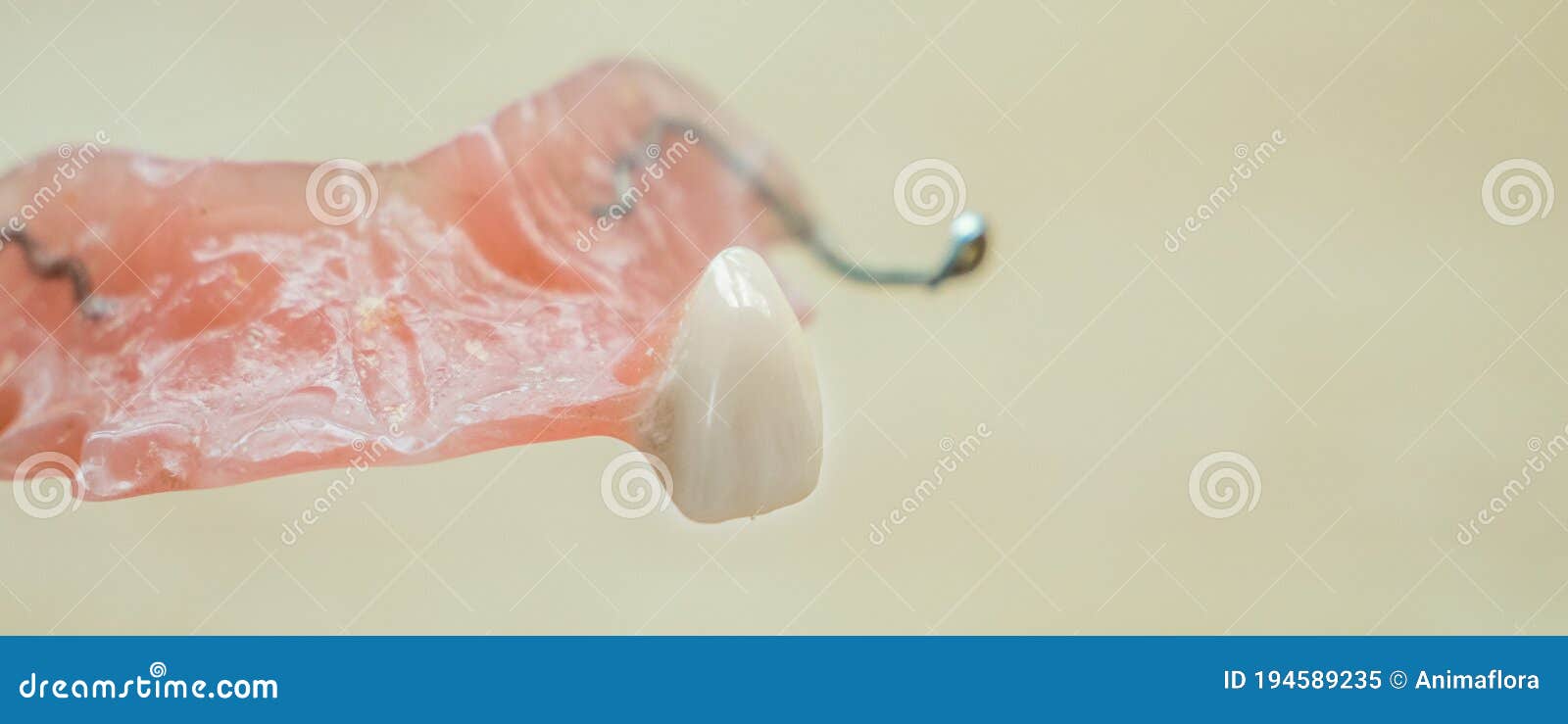 Panorama Tooth Prosthesis with One Tooth Stock Image - Image of ...