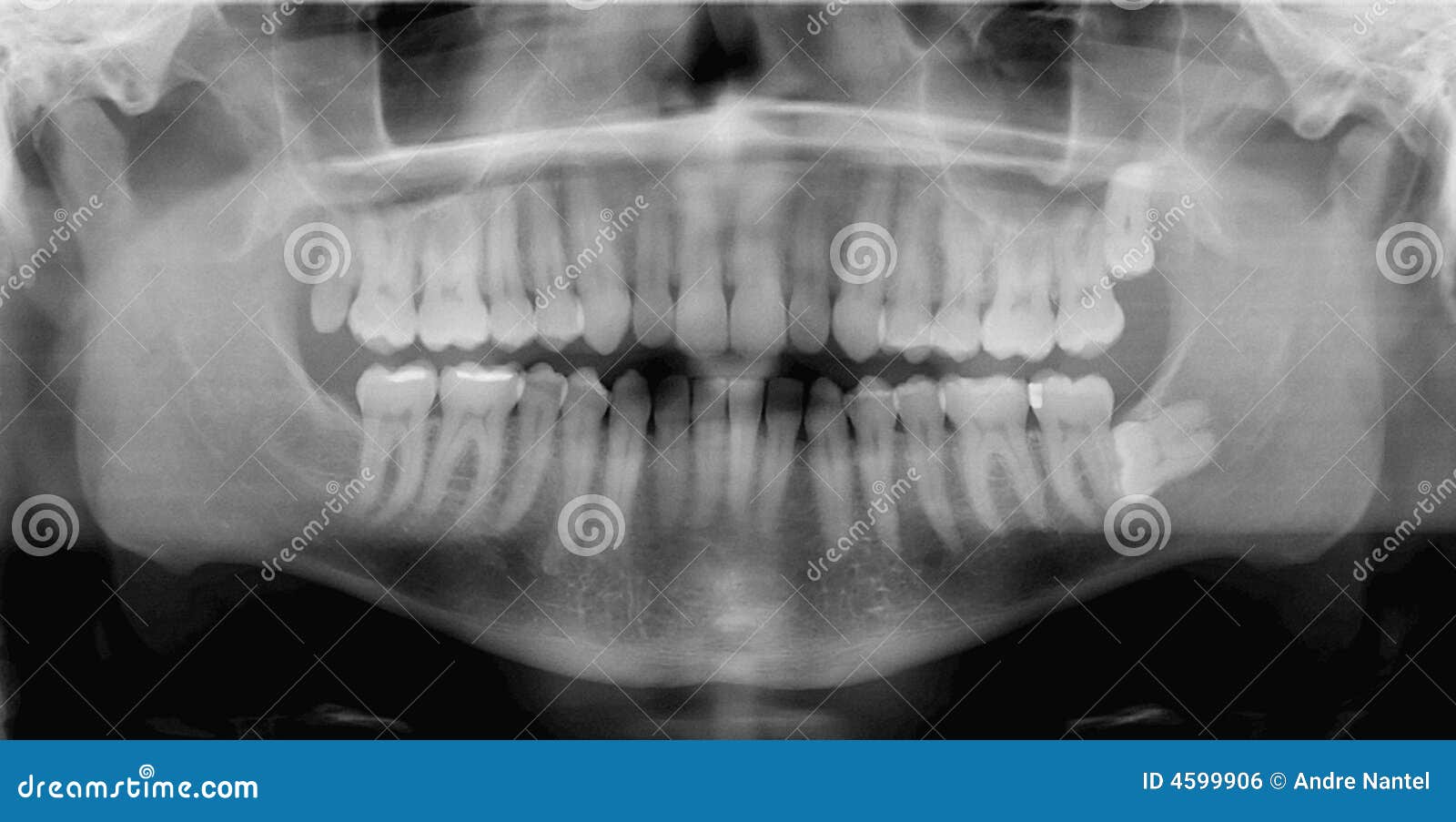 Panoramic Dental X-ray stock photo. Image of black, panoramic - 4599906