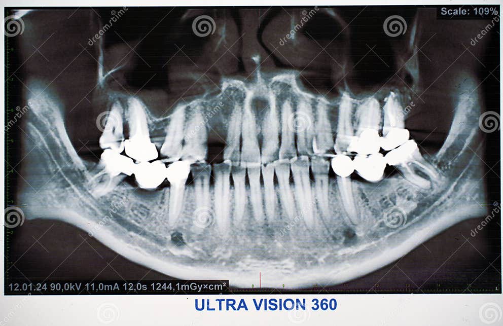 Panoramic Dental X-Ray with Broken Tooth Stock Image - Image of ...