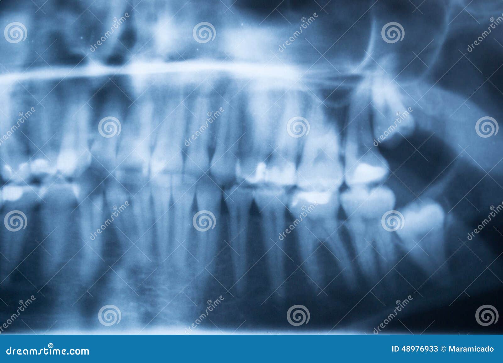 Panoramic Dental X-Ray of Human Teeth Stock Image - Image of skeleton ...