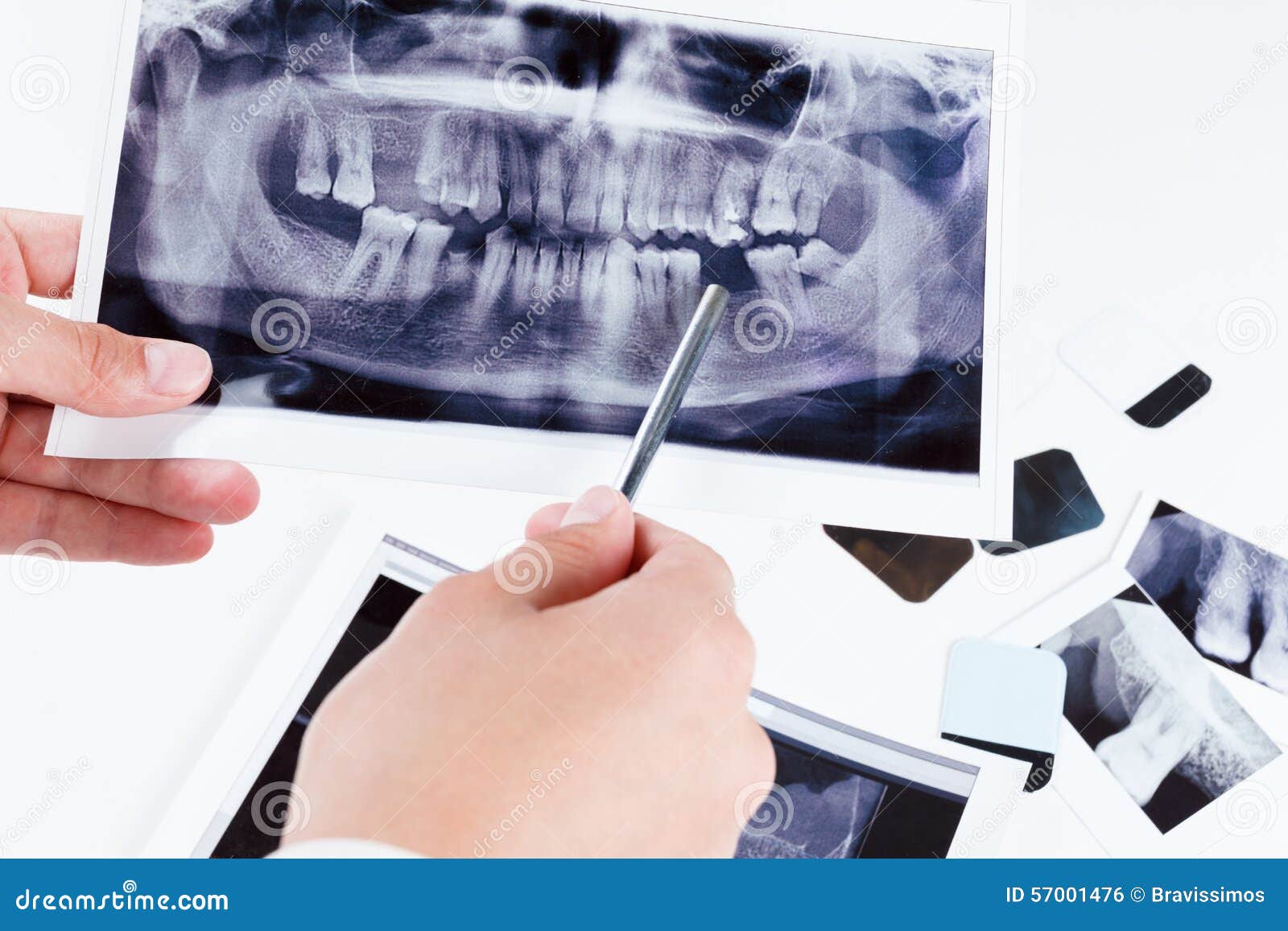 Panoramic Dental X-ray Image of Teeth. Stock Photo - Image of medicine ...