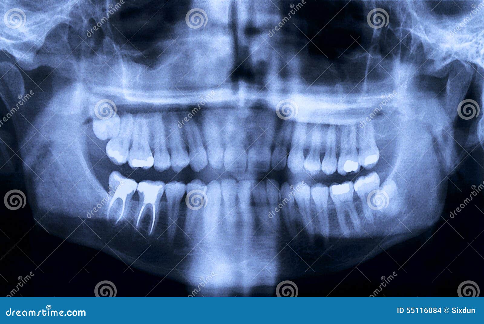 Panoramic dental X-Ray stock photo. Image of medical - 55116084