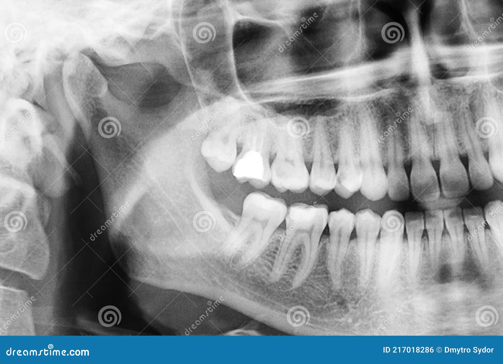 Panoramic Dental X-ray of Oral Cavity with Teeth Stock Photo - Image of ...