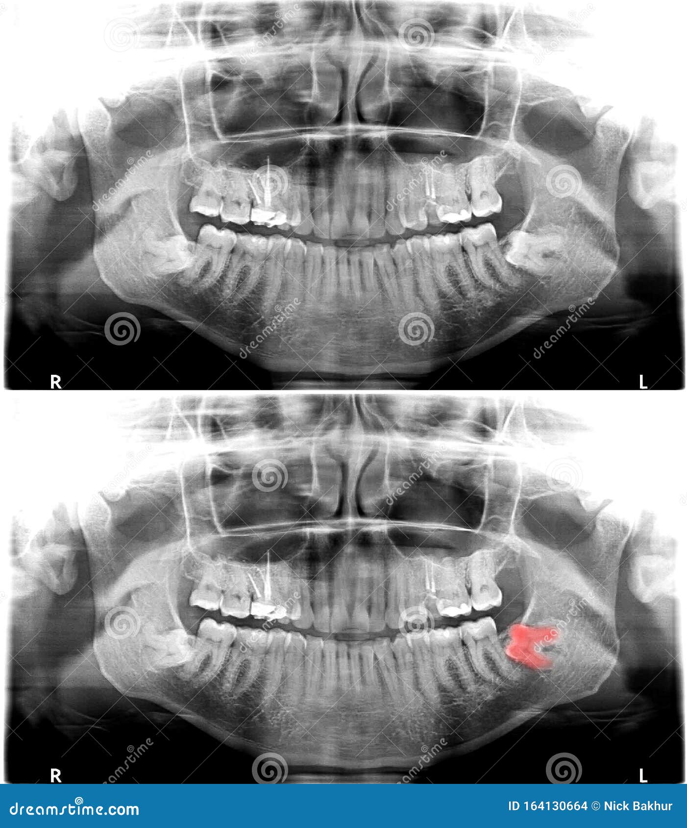 Panoramic Dental X-Ray. Scan Tooth Stock Photo - Image of diagnosis ...