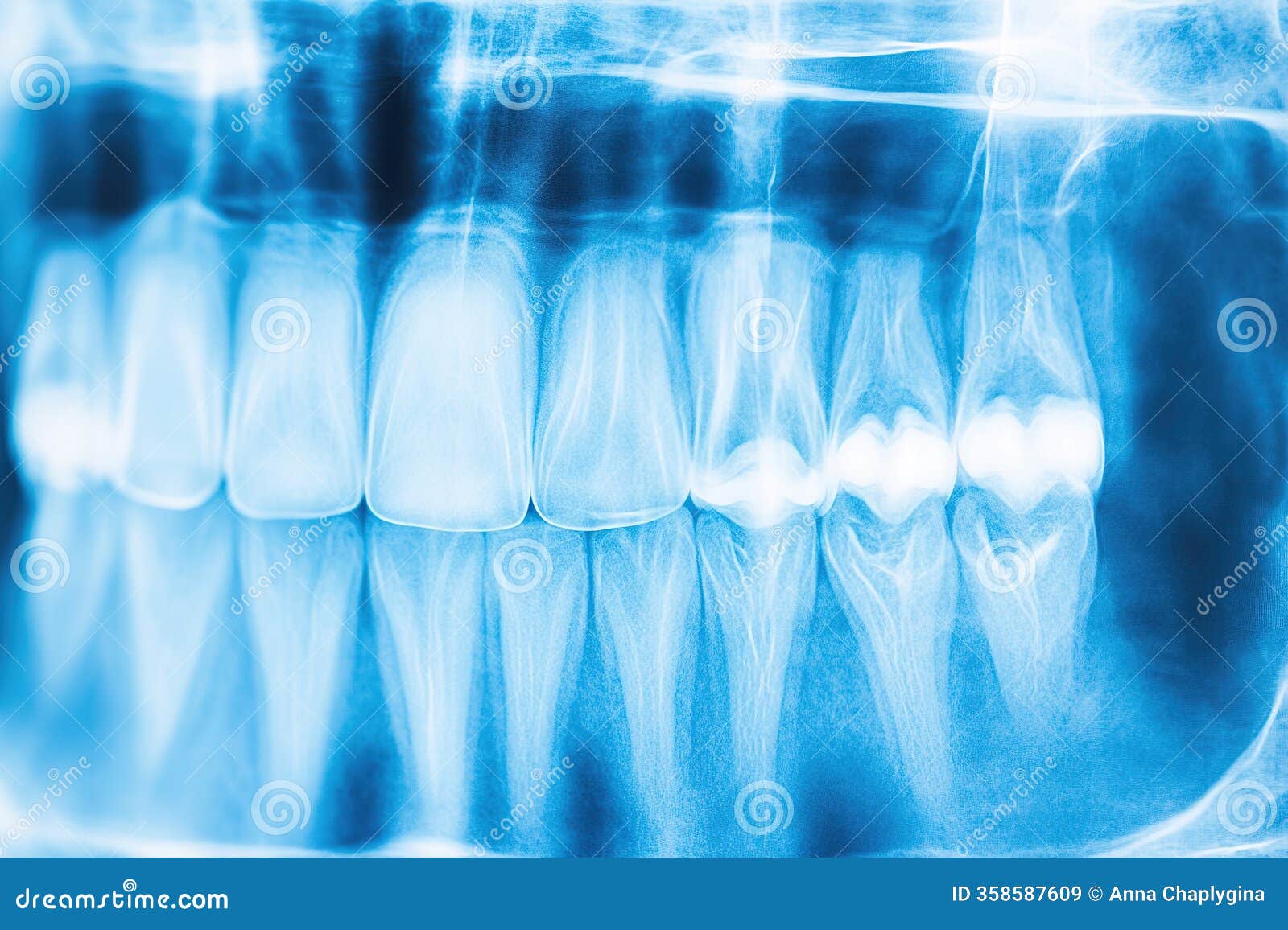 Panoramic Dental X Ray Showing Adult Teeth and Jaw Structure Stock ...