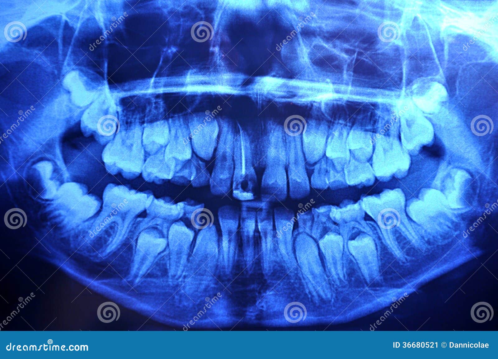 12-year Old - Panoramic Dental X-ray Stock Image - Image of head ...