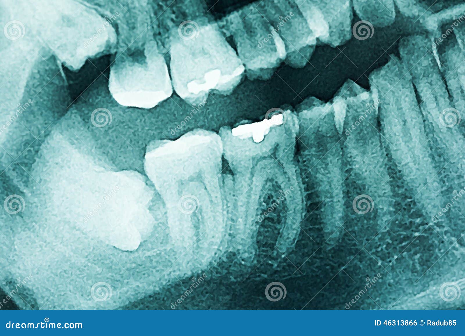 Panoramic Dental X-Ray From A Mouth With Lot Tooth Fillings, Missing ...
