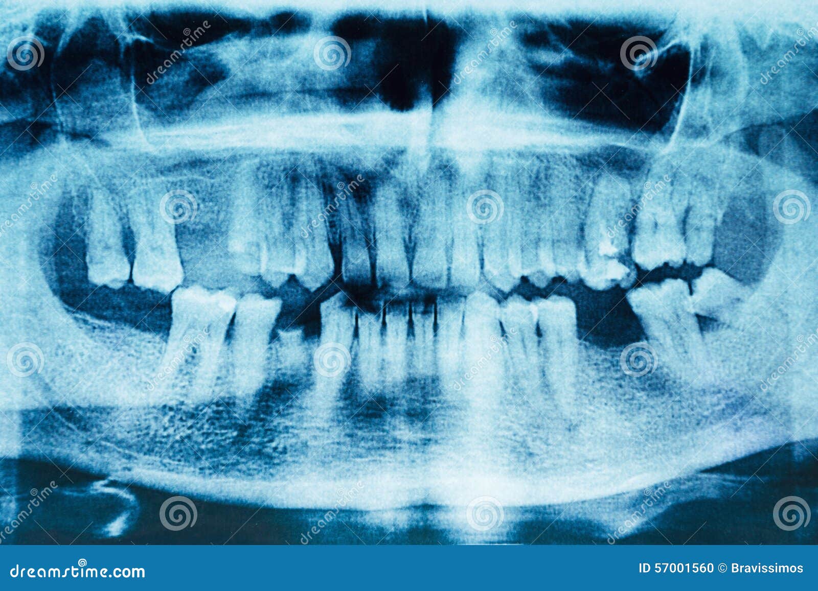 Panoramic Dental X-ray Image Of Teeth. Detail. Stock Photo ...