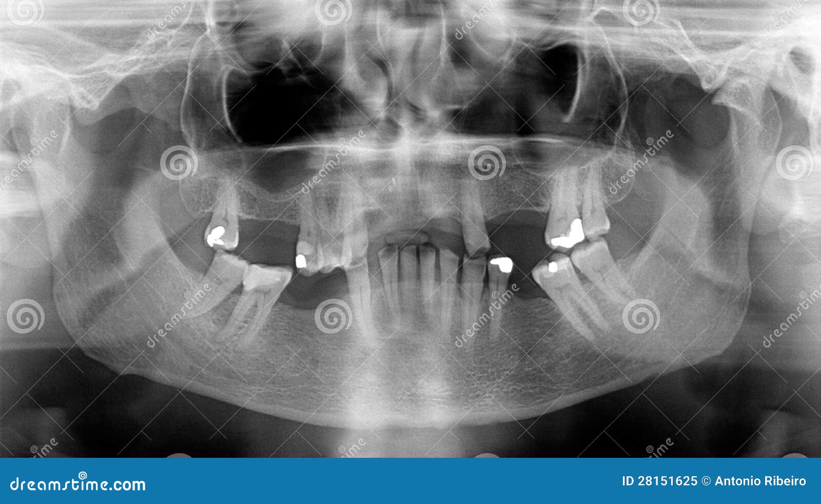 Panoramic Dental X-Rays Royalty Free Stock Photo - Image: 28151625